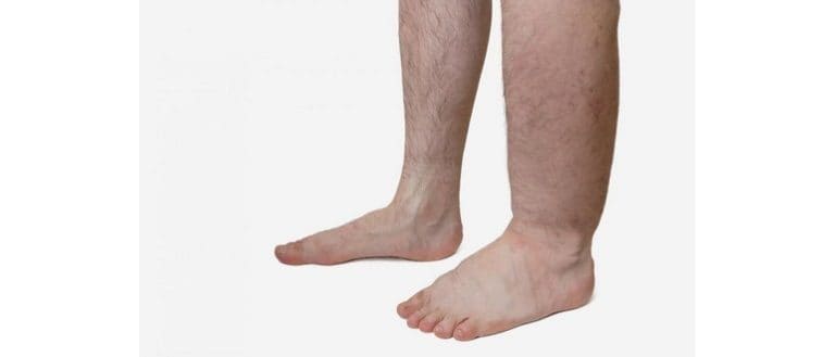 Comprendere l'Edema: Cause, Sintomi e Trattamenti Aggiornati