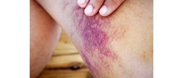 Emorragia Interna: Sintomi, Cause e Trattamenti Essenziali
