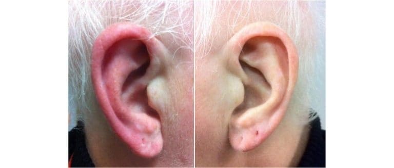 Cause e Trattamenti per Orecchie Calde e Rosse