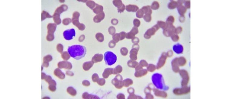 Basofilia: Cause, Sintomi e Trattamenti Aggiornati