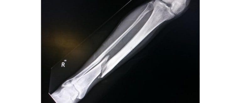 Frattura della Tibia: Sintomi, Trattamenti e Recupero